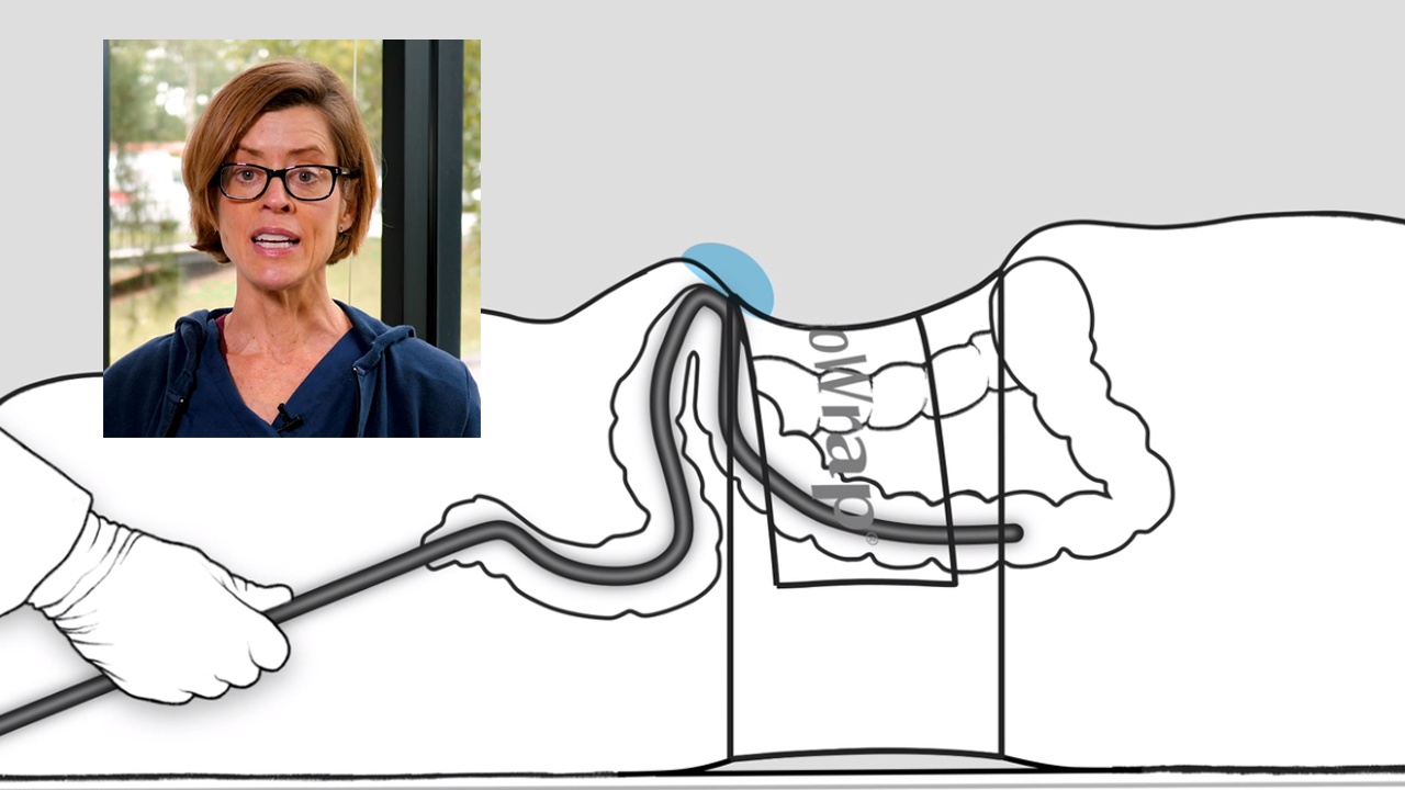 Getting the most out of ColoWrap