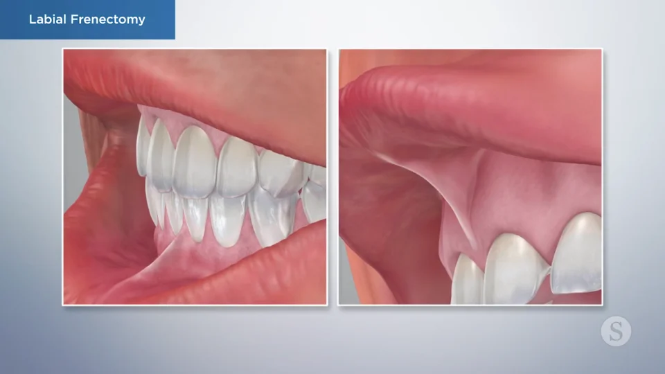 Labial Frenectomy