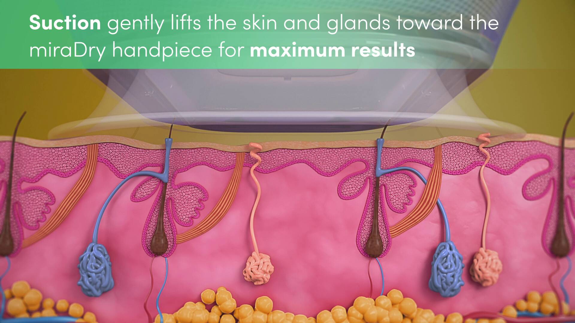 MiraDry for Hyperhidrosis | Edmonton & Calgary — Alberta Sweat Clinic